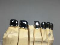 China ODM Dental Prosthesis Crown Telescope Precision Attachment Denture for sale