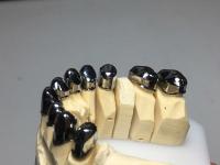 China ODM Dental Prosthesis Crown Telescope Precision Attachment Denture for sale