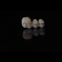China Anti Wear Implant PFM Dental Bridge Prosthesis Teeth Replacement for sale