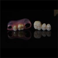 China Anti Wear Implant PFM Dental Bridge Prosthesis Teeth Replacement for sale