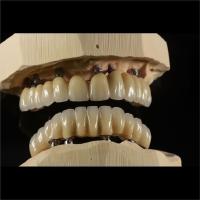 China Cad Cam Implant PFM Crown Bridge Dental Medical Grade Adhesive for sale