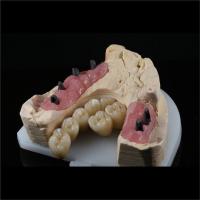 China Cad Cam Implant PFM Crown Bridge Dental Medical Grade Adhesive for sale