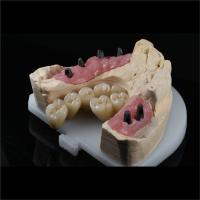 China Cad Cam Implant PFM Crown Bridge Dental Medical Grade Adhesive for sale