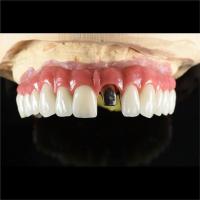 China Fixed Restorations Full Arch Zirconia Implant Bridge Denture Teeth for sale