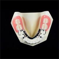 China Co Cr Biocompatibile Metal Cast Framework Partial Dentures ODM for sale