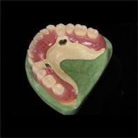 China Peek Thermoplastic Partial Dentures  PEEK Framework for sale
