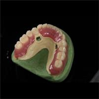 China Peek Thermoplastic Partial Dentures  PEEK Framework for sale