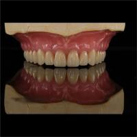 China Removable Smile Full Acrylic Complete Denture Customizable for sale