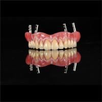 China CAM Milled Titanium Bar Dental Implant Hybrid Prosthesis Dentures for sale