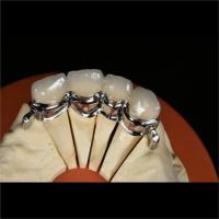 China Aesthetic Partial Denture Precision Attachments Medical Grade OEM for sale