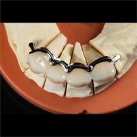 China Aesthetic Partial Denture Precision Attachments Medical Grade OEM for sale