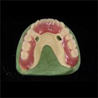 China Removable Telescopic Partial Denture China Dental Lab For Missing Teeth for sale