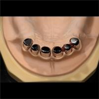 China Removable Telescopic Partial Denture China Dental Lab For Missing Teeth for sale