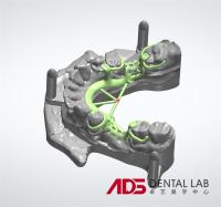 China Concealed Metal Cast Frame Partial Denture Framework Partial Full Arch for sale