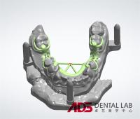 China Concealed Metal Cast Frame Partial Denture Framework Partial Full Arch for sale