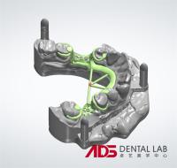 China Concealed Metal Cast Frame Partial Denture Framework Partial Full Arch for sale