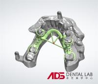 China Concealed Metal Cast Frame Partial Denture Framework Partial Full Arch for sale