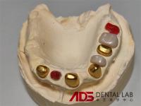 China Dental Telescopic Crowns Prosthesis In Dentistry Customizable for sale