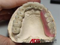 China Dental Telescopic Crowns Prosthesis In Dentistry Customizable for sale