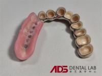 China Dental Telescopic Crowns Prosthesis In Dentistry Customizable for sale