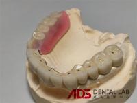 China ADS Precision Attachment Dental Telescopic Crowns Mechanism for sale