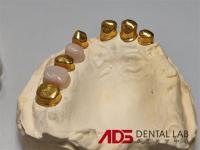 China ADS Precision Attachment Dental Telescopic Crowns Mechanism for sale