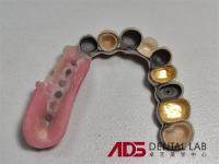 China ADS Precision Attachment Dental Telescopic Crowns Mechanism for sale