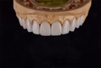 China China Dental Lab Laminate Dental E-Max Veneer Self Adhesive for sale