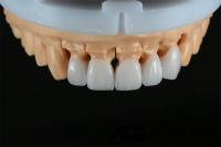 China China Dental Lab Laminate Dental E-Max Veneer Self Adhesive for sale