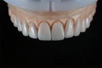 China China Dental Lab Laminate Dental E-Max Veneer Self Adhesive for sale