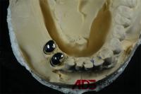 China Custom Metal precision Attachment Partial Denture Telescoper for sale
