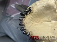 China China Dental Lab Dental Implant Attachments Adjustable Telescopic for sale