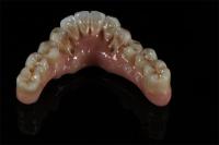 China OEM Cylindrical Titanium Full Bridge Dental Implants All On 4 6 for sale