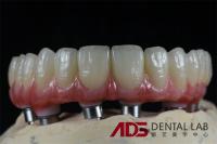 China All On 6 Zirconia Dental Implant Supported Bridge Full Arch Custom for sale