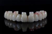 China All On 6 Zirconia Dental Implant Supported Bridge Full Arch Custom for sale