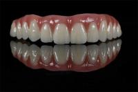 China Biocompatible Titanium All On 6 Dental Implants Bridge For Tooth for sale