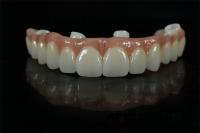 China Biocompatible Titanium All On 6 Dental Implants Bridge For Tooth for sale