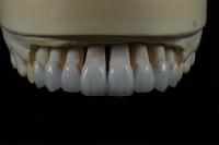 China Long Lasting Permanent White Dental Porcelain Veneers Stain Resistance for sale