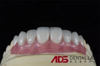 China Long Lasting Permanent White Dental Porcelain Veneers Stain Resistance for sale
