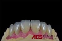 China Handcrafted Porcelain Feldspathic Dental Veneer Natural Looking for sale