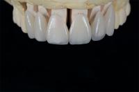 China Dental Natural Porcelain Teeth Veneers Feldspathic Veneer 0.5mm-0.7mm for sale