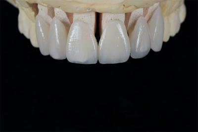 China Dental Natural Porcelain Teeth Veneers Feldspathic Veneer 0.5mm-0.7mm for sale