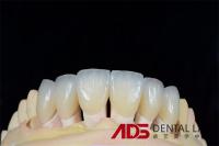 China Dental Porcelain Feldspathic Veneers For Teeth Custom Shaped for sale