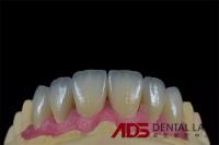 China Dental Porcelain Feldspathic Veneers For Teeth Custom Shaped for sale