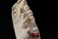 China Natural Looking Crown Composite Inlay Onlay Onlay Inlay Dental OEM for sale