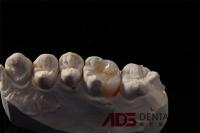 China Strong Biocompatible Dental Composite Ceramic Inlay And Onlay Restorative Services for sale