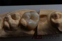 China Customizable Ceramic Inlays And Onlays In Dentistry Restoration for sale