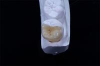 China Dental Crown Composite Inlays And Onlays Restoration Customized Shape for sale