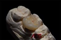 China Precise Ceramic Dental Inlays And Onlays Restoration Stain Resistance for sale