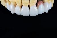 China Dental Porcelain Emax Laminate Veneers Seamlessly Customized for sale